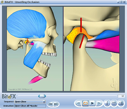 Three Simple Steps to Having Patients Want Their Bite Problems Fixed